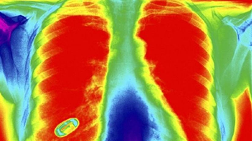 Obec Hybe trápi tuberkulóza - Domáce - Správy - Pravda