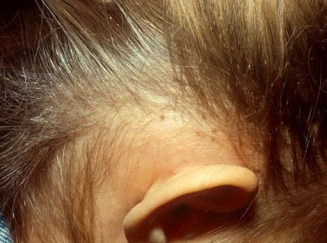 Pozor, vyskytli sa vši! - Zdravá rodina - Zdravie - Pravda.sk